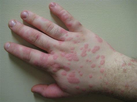 Erythema Multiforme Alchetron The Free Social Encyclopedia