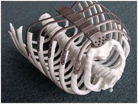 韩研究者成功完成3d打印胸骨移植手术 全球肿瘤快讯 北京大学肿瘤医院 北京大学临床肿瘤学院、北京市肿瘤防治研究所