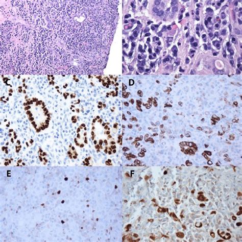 Histopathology Images A Nephrogenic Adenoma With Tubular Pattern Download Scientific Diagram