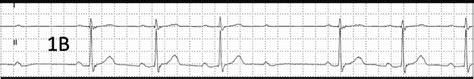 Rare But Significant Cognitive Effects Of Second Degree
