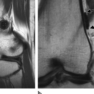 Endobutton Used For Hamstring Graft Fixation In ACL Reconstruction Download Scientific Diagram
