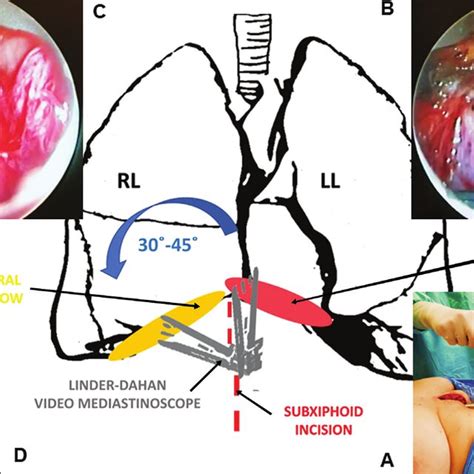 A Using A 3 Cm Subxiphoid Incision The Ligasure Maryland Jaw