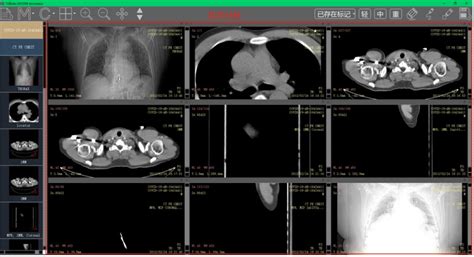 Dicom 影像辅助标注系统 华西生物医学大数据研究院