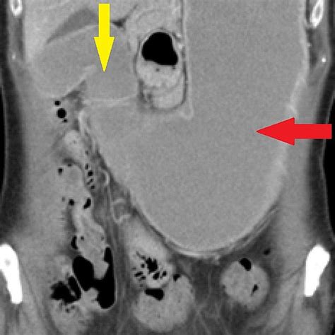 Ct Scan Showing Grossly Distended Stomach The Duodenum Is Not Visible Download Scientific