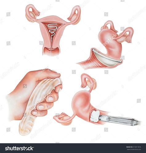 Foam Contraceptive Methods Over 2 Royalty Free Licensable Stock