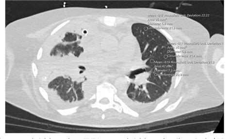 Figure 2 From Photon Counting Detector Ct Allows Significant Reduction