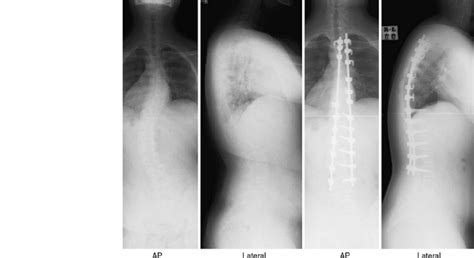 Case With Posterior Correction A Before Surgery B After Surgery C