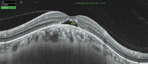 Ss Oct Of Re With Dsm Horizontal Scan The Height Of The Inward Bulge Download Scientific