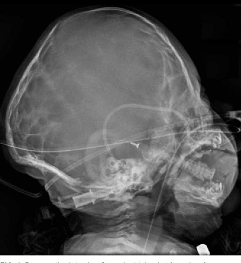 Figure 1 From Spring Assisted Cranial Vault Expansion In The Setting Of