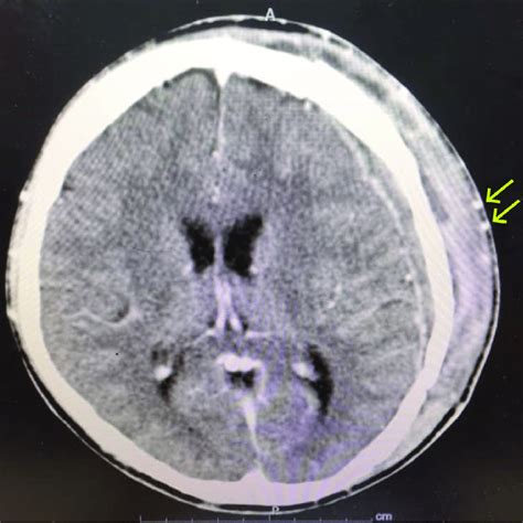Ct Brain Showing Pneumocranium Over Left Frontoparietal Extradural