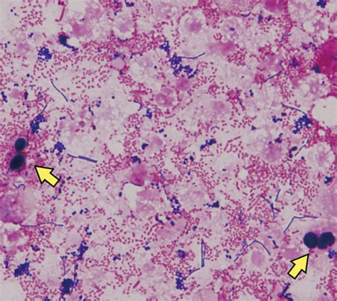 Pyopneumothorax Due To Esophageal Perforation Pmc