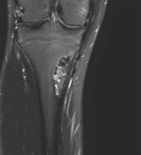 Ossifying Fibroma Radiology