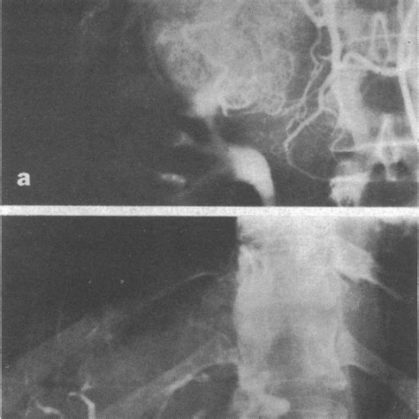 Case 3 Benign Hepatic Adenoma Selective Hepatic Arteriography Before