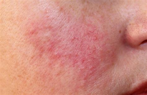 Rosacea Behandling I Se Vores 7 Gode Råd I Symptomer Pleje M M