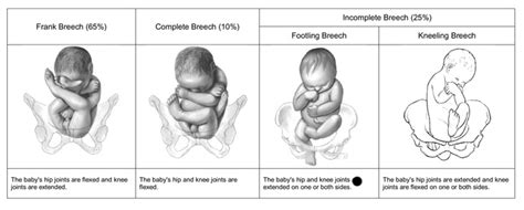Breech Presentation Repropedia