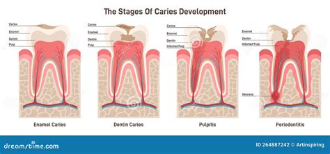 Caries Development Dental Disease Stages Enamel And Dentin Caries Stock Illustration