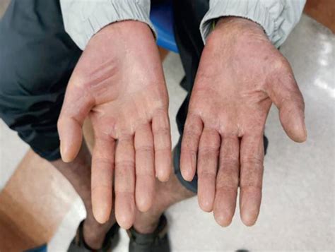 A Erythema And Desquamation Seen Over Both Palms Due To Cutaneous