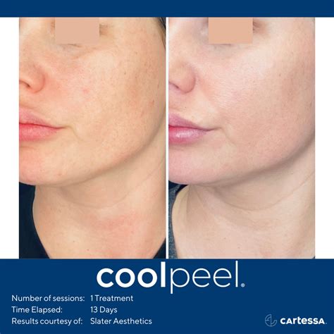 Tetra Co2 Coolpeel Laser Treatment Jim Brantner Md