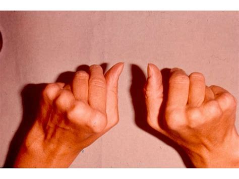 Классификация ревматоидного артрита презентация онлайн