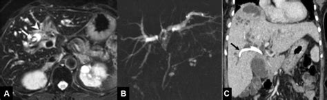 A 61 Year Old Male With Mid Common Bile Duct Cholangiocarcinoma Post Download Scientific