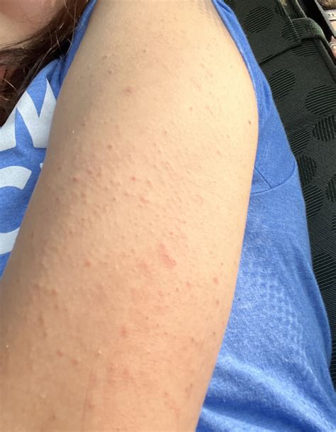 How To Treat Keratosis Pilaris On Arms Gigabrain
