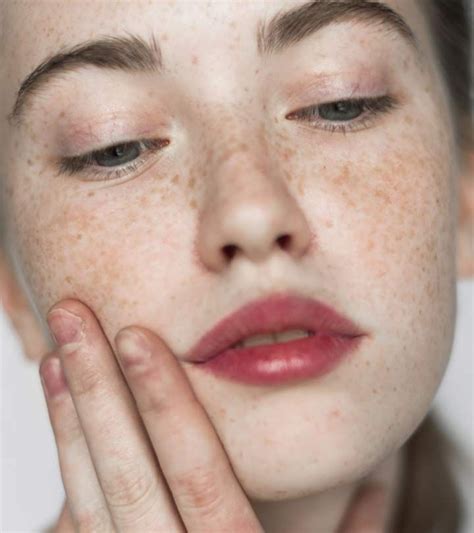 3 Ways To Treat Hyperpigmentation And Tips To Prevent It Akne