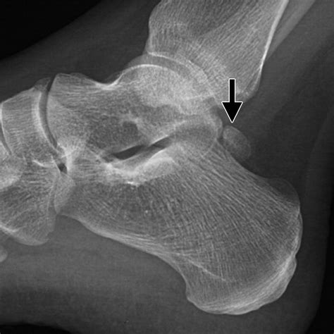 Talus Bone Fracture Xray At Luis Manson Blog