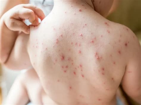 ХӨСҮТ Улаанбурхан өвчний лабораториор батлагдсан тохиолдол 9251 болжээ