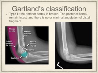 Supracondylar Fracture Pptx