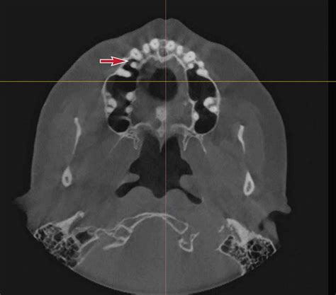 Extensive Maxillary Sinus Pneumatization A Clinico Radiological Case Report Decisions In