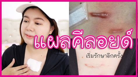 Ep24 2 แชร์วิธีรักษาคีลอยด์ รักษาต่อจากep 24 อาทิตย์แรก Youtube