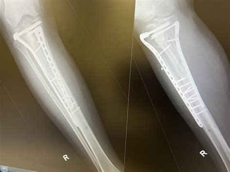 Right Comminuted Tibial Fracture ORIF R Brokenbones