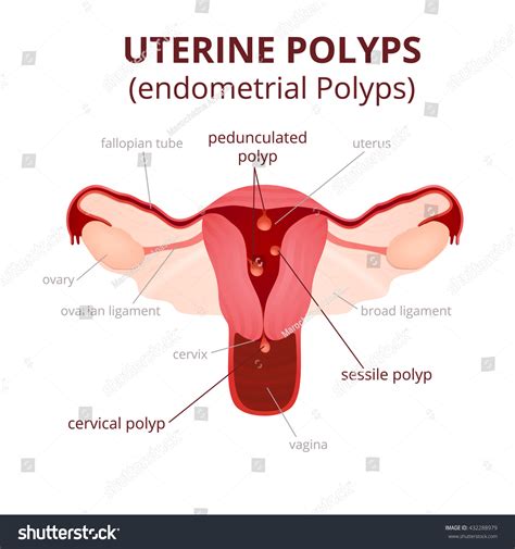 Endocervical Polyp Over 52 Royalty Free Licensable Stock Illustrations And Drawings Shutterstock