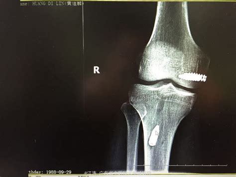 后交叉韧带损伤关节镜下y型人工韧带股骨双束重建 医联