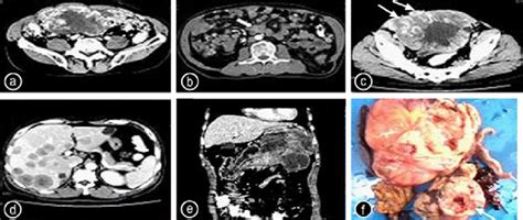 The Ct Features Of The Malignant Gist A And B Mesenteric Gist In A
