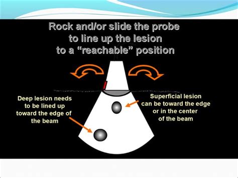 Usg Guided Fna Biopsy Ppt