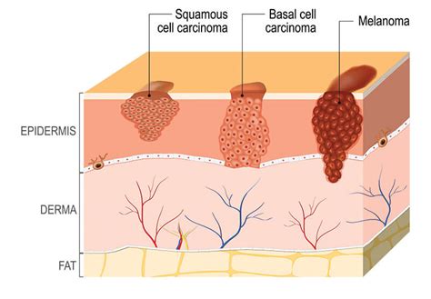 Types Of Skin Cancer Diagram Advancements In Nanoparticle Based
