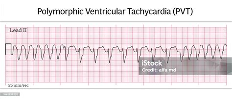 Polymorphic Ventricular Tachycardia Vs Ventricular Fibrillation