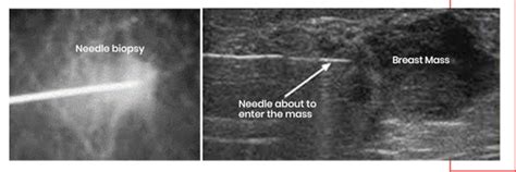 Breast Biopsy And Womens Imaging Expert Breast Care