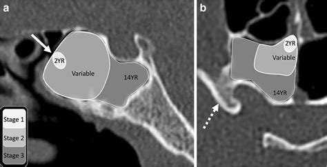 Sphenoid Sinus Development In A 21 Year Old Man A B Sagittal A And