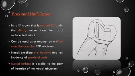 Partial Coverage Restorationspdf
