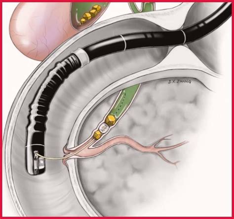 급성 췌장염acute Pancreatitis 총정리간호치료증상당뇨췌장 기능약물진단검사 네이버 블로그
