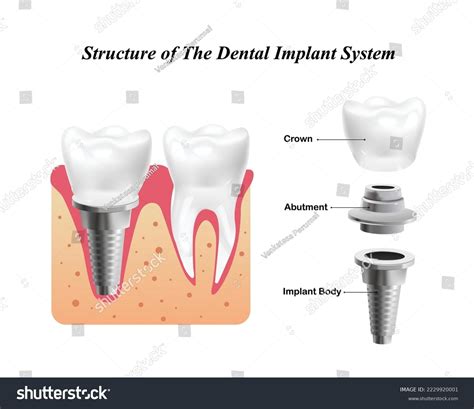 Structure Dental Implant System Tooth Implant Stock Vector Royalty