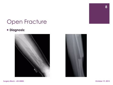 Open Fractures Pptx