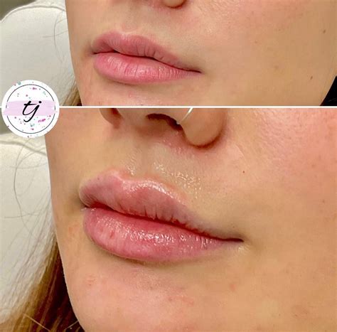 Lip Injections Brentwood Tn Schaffer Skin