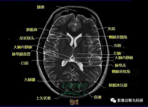 全新解剖系列：颅脑mr影像解剖冠状位横断位颅脑解剖 健康界