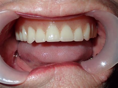 Dentures Before And Afters In La Mesa Ca San Diego Dental Center