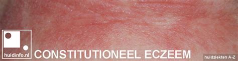 Constitutioneel Eczeem Info Van De Dermatoloog