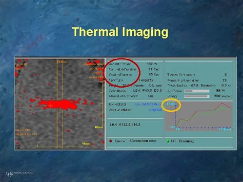 Magnetic Resonanceguided Focused Ultrasound Of Uterine Fibroids Patient