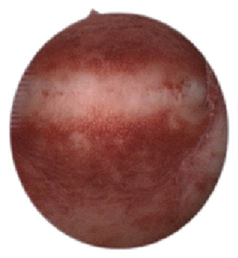 Different Features Of Chronic Endometritis At Fluid Hysteroscopy A